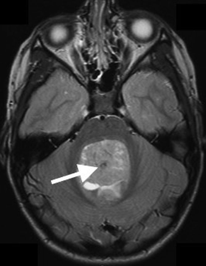Posterior Fossa Tumours - Dr. Vinay M. Rohra